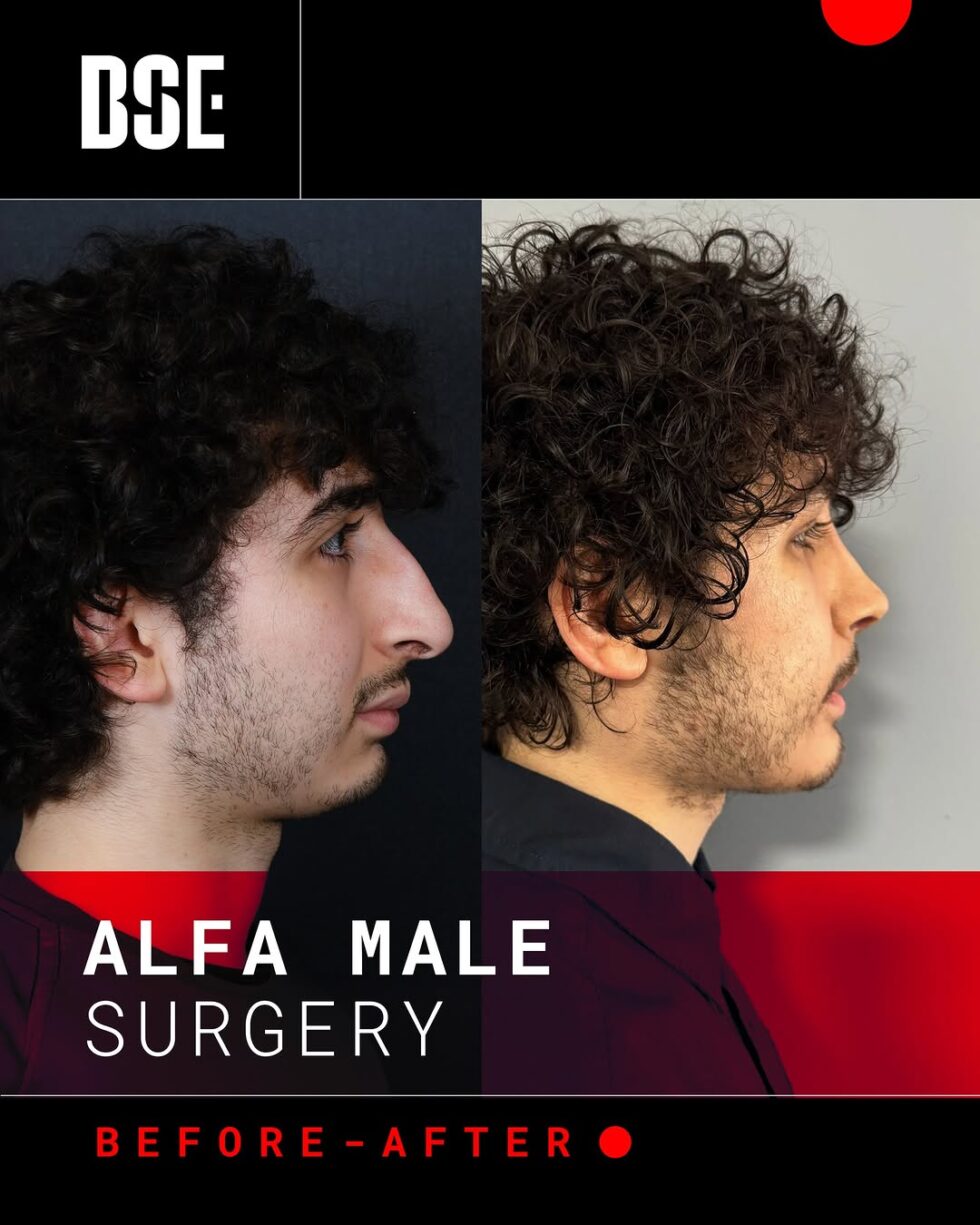 Alpha Male Plastic Surgery in Turkey | Dr. Burak Sercan Erçin
