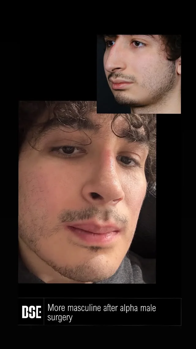 Alpha Male Facelift in Turkey - Assoc. Prof. Dr. Burak Sercan